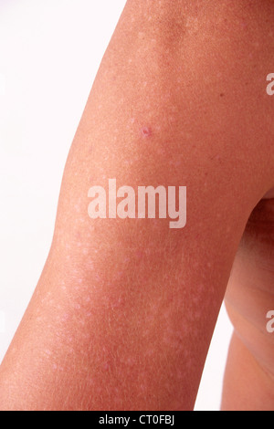 POLYMORPHOUS LIGHT ERUPTION Stock Photo - Alamy