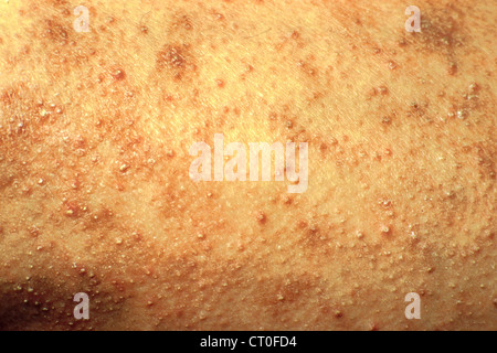 PITYRIASIS RUBRA PILARIS Stock Photo - Alamy
