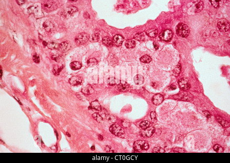 PROSTATE CANCER, HISTOLOGY Stock Photo - Alamy