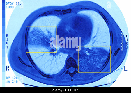 PNEUMOCOCCAL PNEUMONIA, SCAN Stock Photo - Alamy