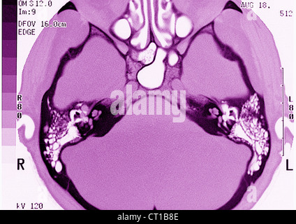 INTERNAL EAR, MRI Stock Photo: 49203304 - Alamy