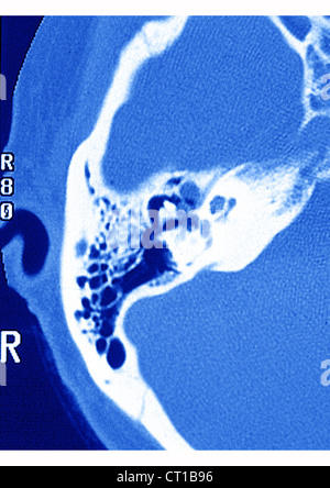 INTERNAL EAR, MRI Stock Photo - Alamy