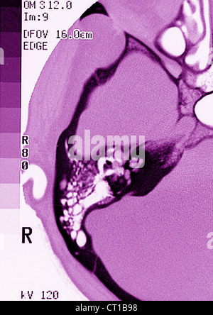 INTERNAL EAR, MRI Stock Photo - Alamy