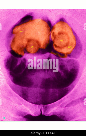 The hysterosalpingography or hysterography is an X-ray of the uterus ...