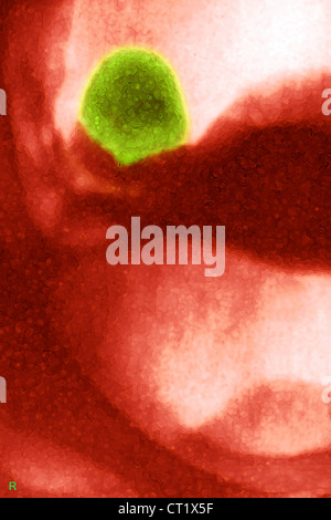 OVARY HYPERTROPHY, X-RAY Stock Photo - Alamy
