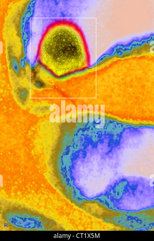 OVARY HYPERTROPHY, X-RAY Stock Photo - Alamy