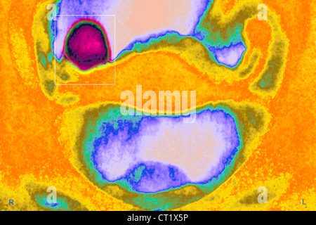 OVARY HYPERTROPHY, X-RAY Stock Photo - Alamy