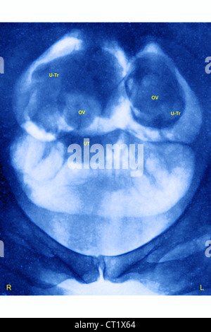 The hysterosalpingography or hysterography is an X-ray of the uterus ...