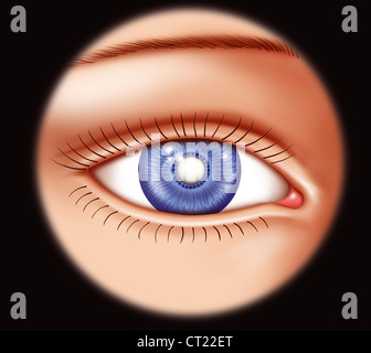 CATARACT, DRAWING Stock Photo - Alamy