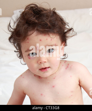 Toddler child, boy with chicken pox, mild rash, first stage of the ...