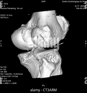 KNEE OSTEOARTHRITIS, 3D SCAN Stock Photo - Alamy