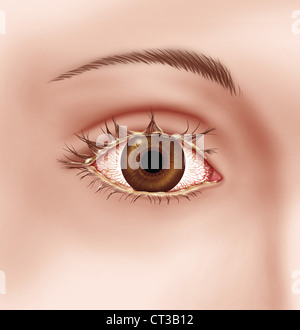 INFECTIOUS CONJUNCTIVITIS, DRAW Stock Photo - Alamy