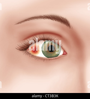 NODULAR SCLERITIS, DRAWING Stock Photo - Alamy