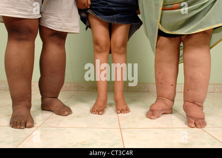 Congenital Diseases Edema Feet Stock Photo - Alamy