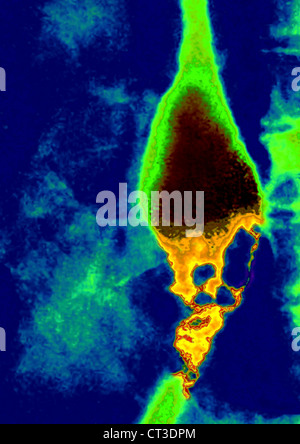 ESOPHAGEAL CARCINOMA, X-RAY Stock Photo - Alamy