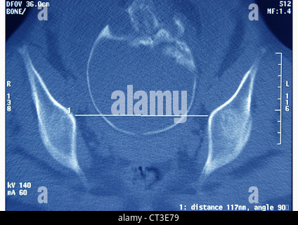 PELVIMETRY Stock Photo: 49249545 - Alamy
