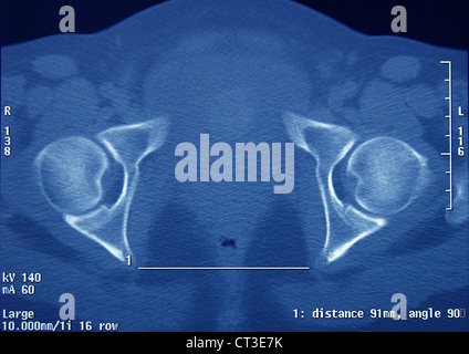 PELVIMETRY Stock Photo: 49249545 - Alamy