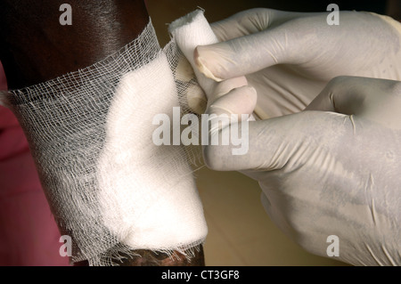 Squamous cell carcinoma (SCC) skin cancer on the scalp of a 92 year old ...