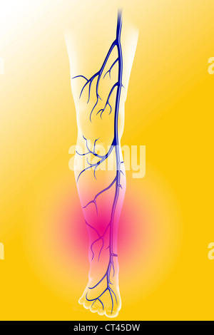 LEG PAIN, DRAWING Stock Photo - Alamy