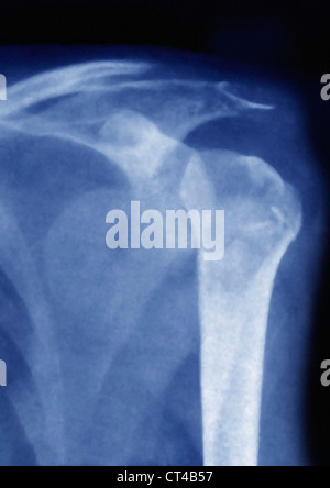 Dislocated shoulder, X-ray Stock Photo - Alamy