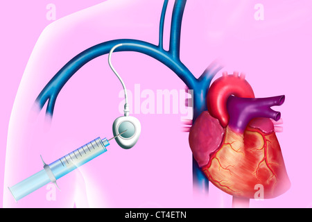VENOUS ACCESS PORT Stock Photo - Alamy