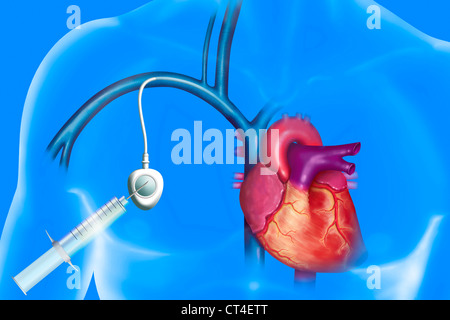 VENOUS ACCESS PORT Stock Photo - Alamy