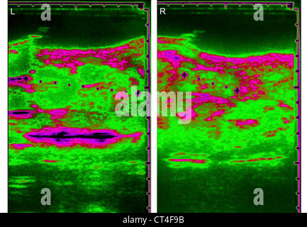 MULTICYSTIC DYSPLASTIC KIDNEY Stock Photo - Alamy