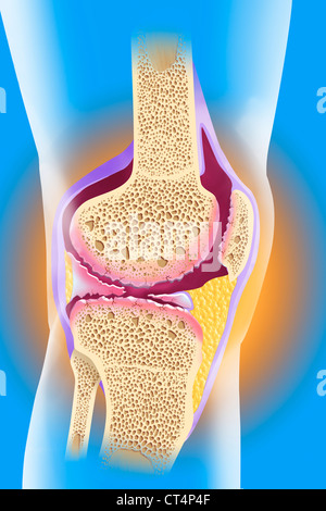 KNEE OSTEOARTHRITIS, DRAWING Stock Photo - Alamy