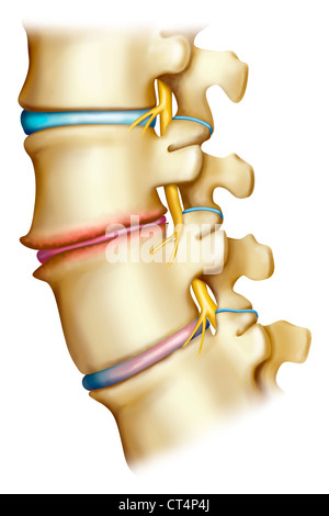 Illustration of spondylosis of the lumbar vertebrae (lumbar arthrosis ...