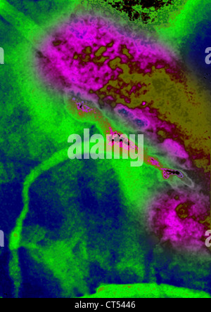 KIDNEY ABSCESS, X-RAY Stock Photo - Alamy