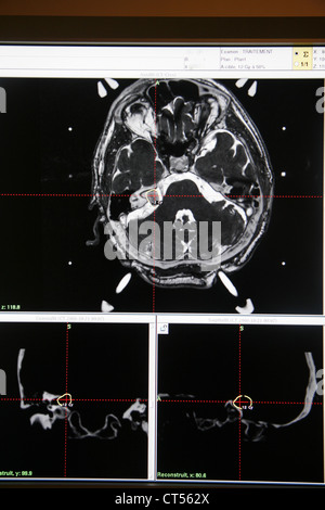 ACOUSTIC NEUROMA, SCAN Stock Photo - Alamy