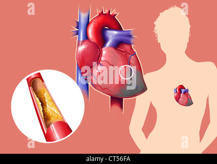 HEART ATTACK, DRAWING Stock Photo - Alamy