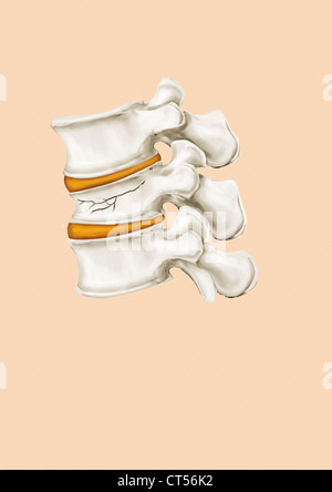 COMPRESSION FRACTURE, DRAWING Stock Photo - Alamy