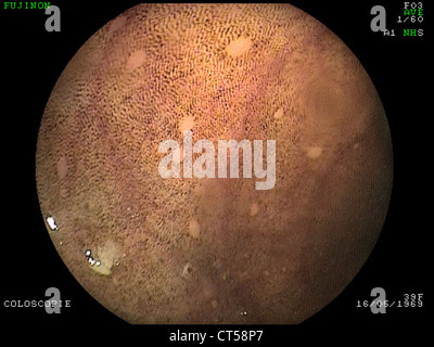 MELANOSIS COLI, ENDOSCOPY Stock Photo - Alamy