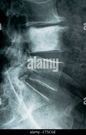 IVORY VERTEBRA, X-RAY Stock Photo - Alamy