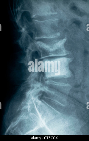 IVORY VERTEBRA, X-RAY Stock Photo - Alamy