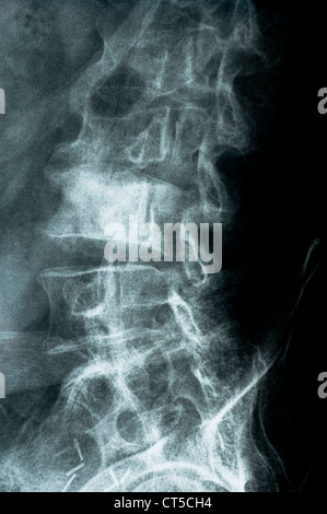 IVORY VERTEBRA, X-RAY Stock Photo - Alamy
