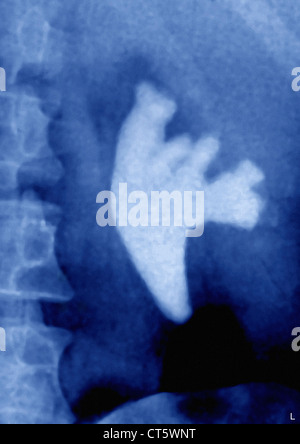 RENAL LITHIASIS, X-RAY Stock Photo - Alamy