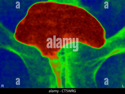 PROSTATIC CALCULUS, X-RAY Stock Photo - Alamy