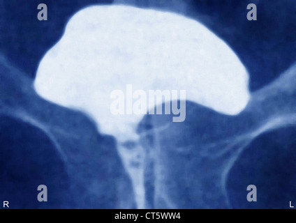 PROSTATIC CALCULUS, X-RAY Stock Photo - Alamy
