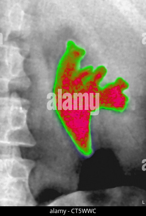 RENAL LITHIASIS, X-RAY Stock Photo - Alamy