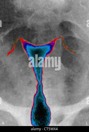 The hysterosalpingography or hysterography is an X-ray of the uterus ...