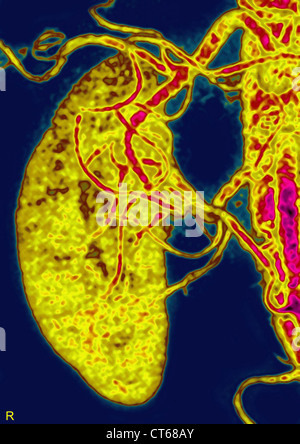 KIDNEY ARTERY, 3D SCAN Stock Photo - Alamy