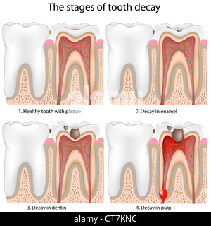 Tooth decay and blood bacteria and disease as an unhealthy molar with ...
