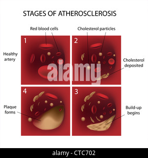 Atherosclerosis stages, illustration Stock Photo - Alamy