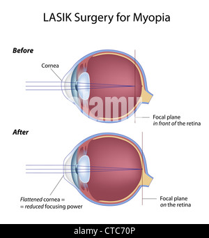 Illustration of LASIK (Laser-Assisted In Situ Keratomileusis) also ...