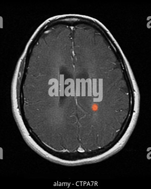 MRI showing multiple sclerosis in a 42 year old woman Stock Photo - Alamy