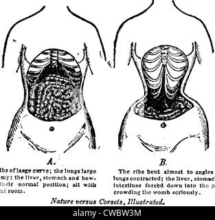 'Nature Versus Corsets.' At left is the natural arrangement of a woman ...