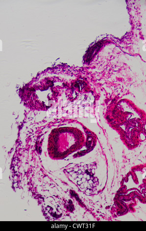 Lymphoma Lymph Node Cancer Anatomy spreading in the Lymphatic system as ...