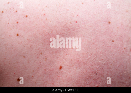 Close-up of skin cancer (basal cell carcinoma) behind the pinna of the ...